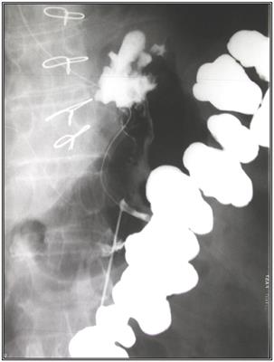 Frontiers | Gastrostomy Tube Placement by Radiological Methods for ...