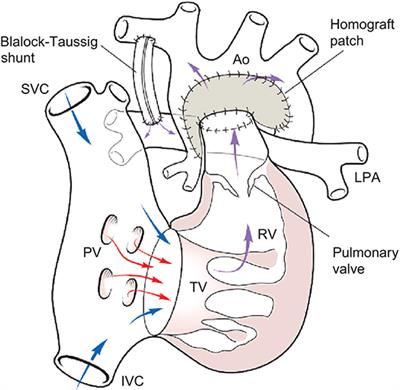 Frontiers | Mechanical Circulatory Support for Single Ventricle Failure
