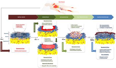 Phases Of Burn Healing