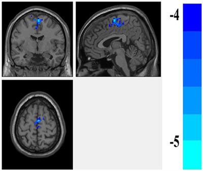 Frontiers | The Role of Amygdala in Patients With Euthymic Bipolar ...