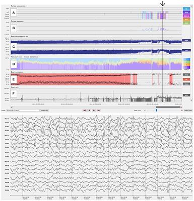 Frontiers | Automated Long-Term EEG Review: Fast and Precise Analysis ...