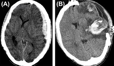 Frontiers | Complications of Decompressive Craniectomy