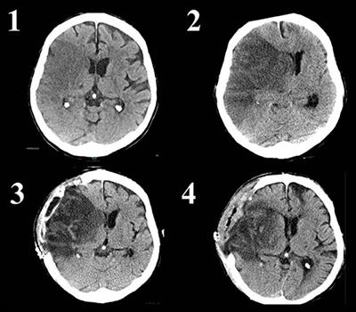 Frontiers | Role of Decompressive Craniectomy in Ischemic Stroke