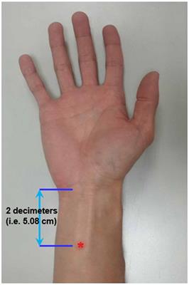 Frontiers | Paired Associative Electroacupuncture and Transcranial ...