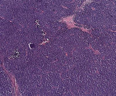 Frontiers | Rescue of Immunotherapy-Refractory Metastatic Merkel Cell ...