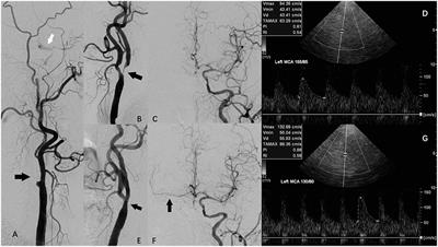 Frontiers | Hemodynamic Surveillance of Unilateral Carotid Artery ...