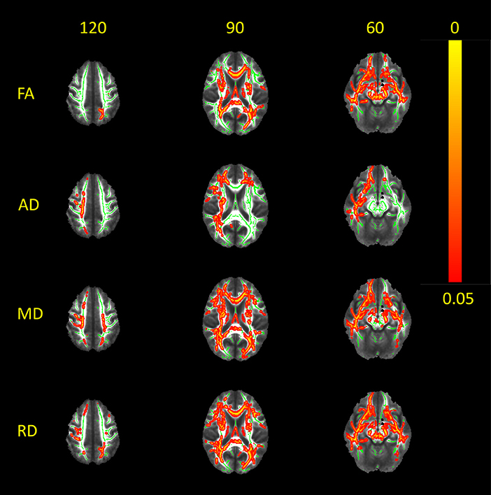 Frontiers | Distinctive Patterns of Seizure-Related White Matter ...