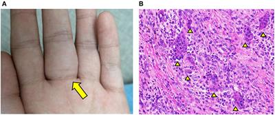 Frontiers | Giant Cell Tumor of Tendon Sheath and Tendinopathy as Early ...