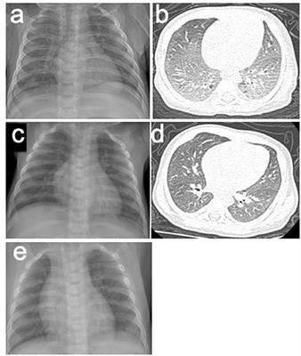 Frontiers | Hematochezia in a Child With Heiner Syndrome