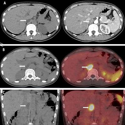 Frontiers | A Rare Aldosterone-Producing Adenoma Detected by 68Ga ...