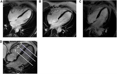 Frontiers | A Pilot Study of Cardiac MRI in Breast Cancer Survivors ...