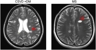 Frontiers | Dawson's Fingers in Cerebral Small Vessel Disease