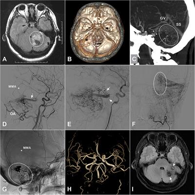 Frontiers | Intracranial Dural Arteriovenous Fistulas With Brainstem ...