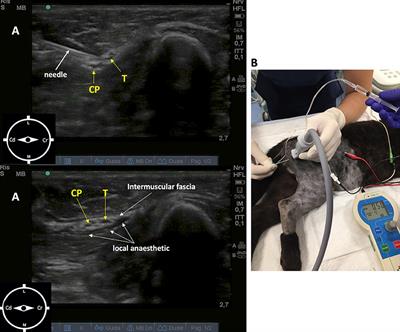 Saphenous Nerve Block