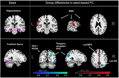 Frontiers | Distinct Functional Connectivity Signatures of Impaired ...