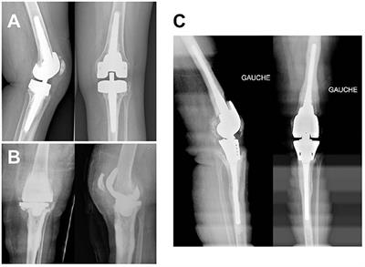Frontiers | Rotating Hinge Knee Arthroplasty for Revision Prosthetic ...
