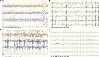 Frontiers | FARS2 Mutations: More Than Two Phenotypes? A Case Report