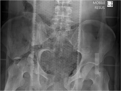 Pelvic Fracture X Ray