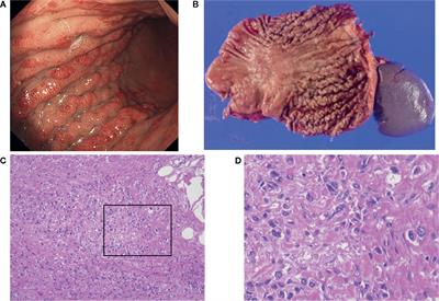 Frontiers | Crosstalk Between Cancer Associated Fibroblasts and Cancer ...