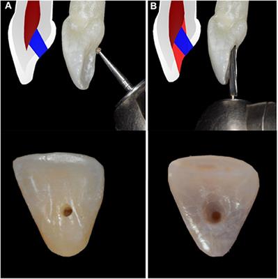 Frontiers | Influence of Endodontic Access Cavity Design on Fracture ...