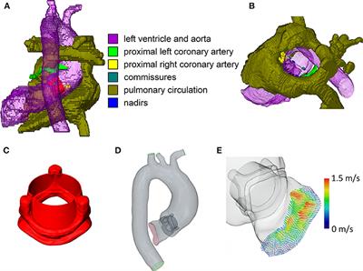 Frontiers | Hemodynamic Modeling of Biological Aortic Valve Replacement ...