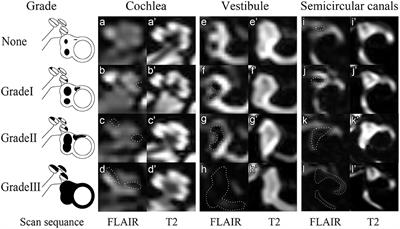 Frontiers | The Correlation of a 2D Volume-Referencing Endolymphatic ...