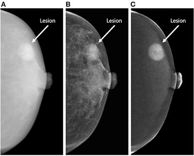 Frontiers | Radiomic Analysis of Contrast-Enhanced Mammography With ...