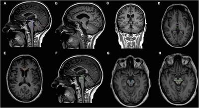 Cerebral Palsy Brain Scan Comparison