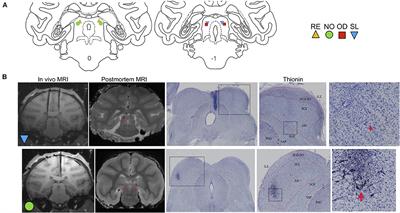 Inferior Colliculus Mri