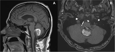 Frontiers | Case Report: Endovascular Treatment of a Giant Distal PICA ...