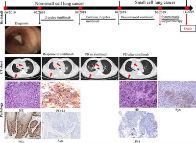 Frontiers | Case Report: Transformation From Non-Small Cell Lung Cancer ...