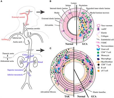 Frontiers | The Immunopathology of Giant Cell Arteritis Across Disease ...