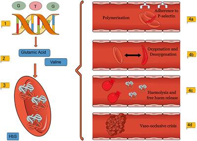 Frontiers | In utero Therapy for the Treatment of Sickle Cell Disease ...