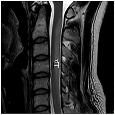 Abnormal Cervical Spine Mri