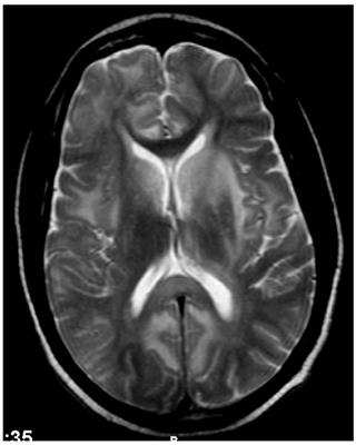Frontiers | HIV-Associated CD8 Encephalitis: A UK Case Series and ...