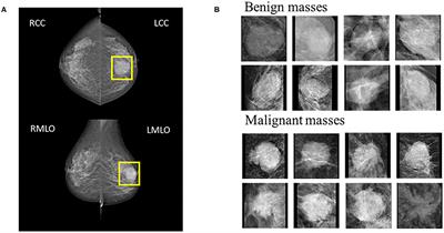 Frontiers | Improving the Prediction of Benign or Malignant Breast ...