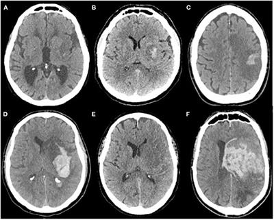 Frontiers | Intracranial Bleeding After Reperfusion Therapy in Acute ...
