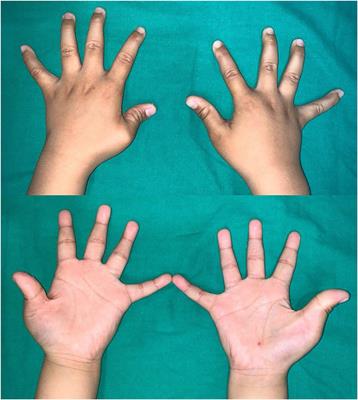 Frontiers | Characteristics of Congenital Clasped Thumb: A Case Report ...