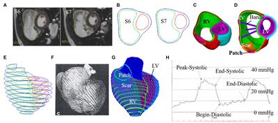Frontiers | A Novel Pulmonary Valve Replacement Surgery Strategy Using ...