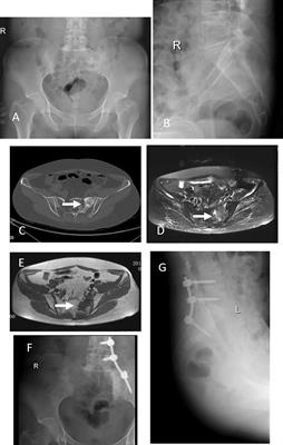 Frontiers | Surgical Treatment of Sacral Metastatic Tumors
