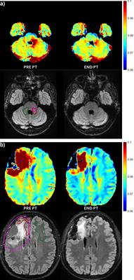 Frontiers | Quantitative Multicomponent T2 Relaxation Showed Greater ...
