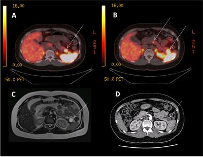 Frontiers | The Impact of 68Gallium DOTA PET/CT in Managing Patients ...