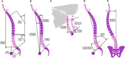 Frontiers | Complicated Postoperative Flat Back Deformity Correction ...