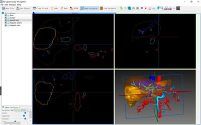 Frontiers | Augmented Reality Navigation for Stereoscopic Laparoscopic ...