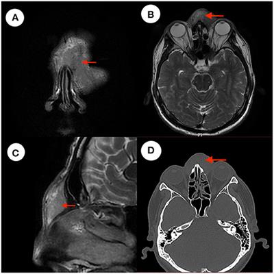 Frontiers | Case Report: A Rare Case of Nasal Forehead Mass in Kimura's ...