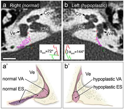 Frontiers | Radiological Configuration of the Vestibular Aqueduct ...