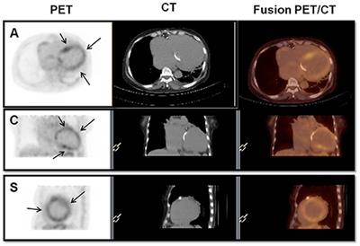 Frontiers | Rheumatic Myocarditis: A Poorly Recognized Etiology of Left ...