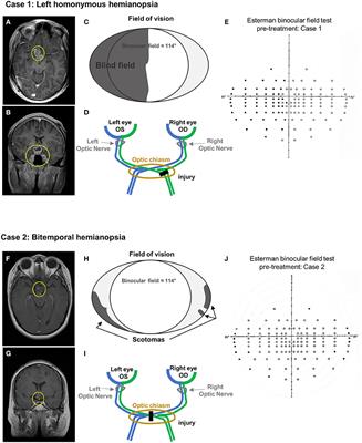 Frontiers | Case Report: Visual Rehabilitation in Hemianopia Patients ...