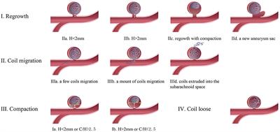 Frontiers | Surgical Clipping of Previously Coiled Recurrent ...