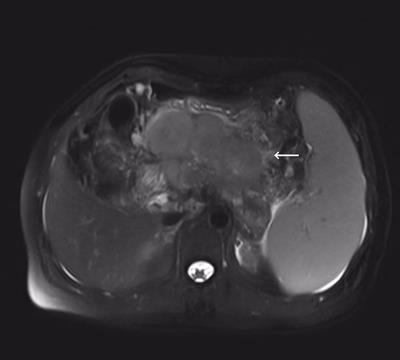 Frontiers | Case Report: Squamous Cell Carcinoma of Pancreas With High ...